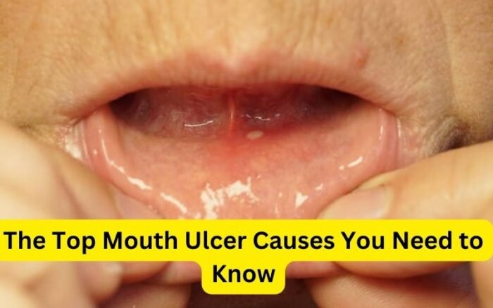 The Top Mouth Ulcer Causes You Need To Know