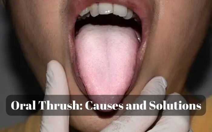 Dealing with Oral Thrush: Causes and Solutions
